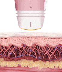 台中海芙電波推薦專業的醫美團隊『禾伊美學診所』