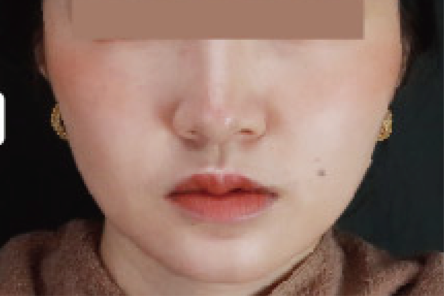 台中海芙音波推薦專業的醫美團隊『禾伊美學診所』