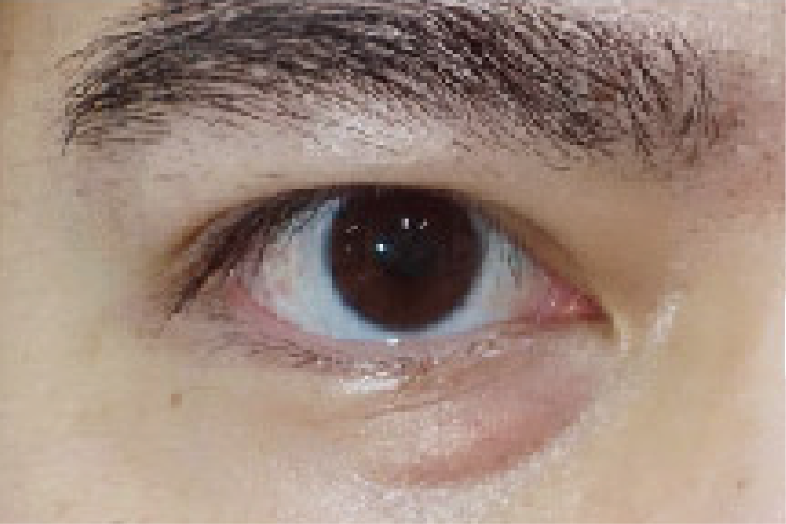 台中海芙音波推薦專業的醫美團隊『禾伊美學診所』