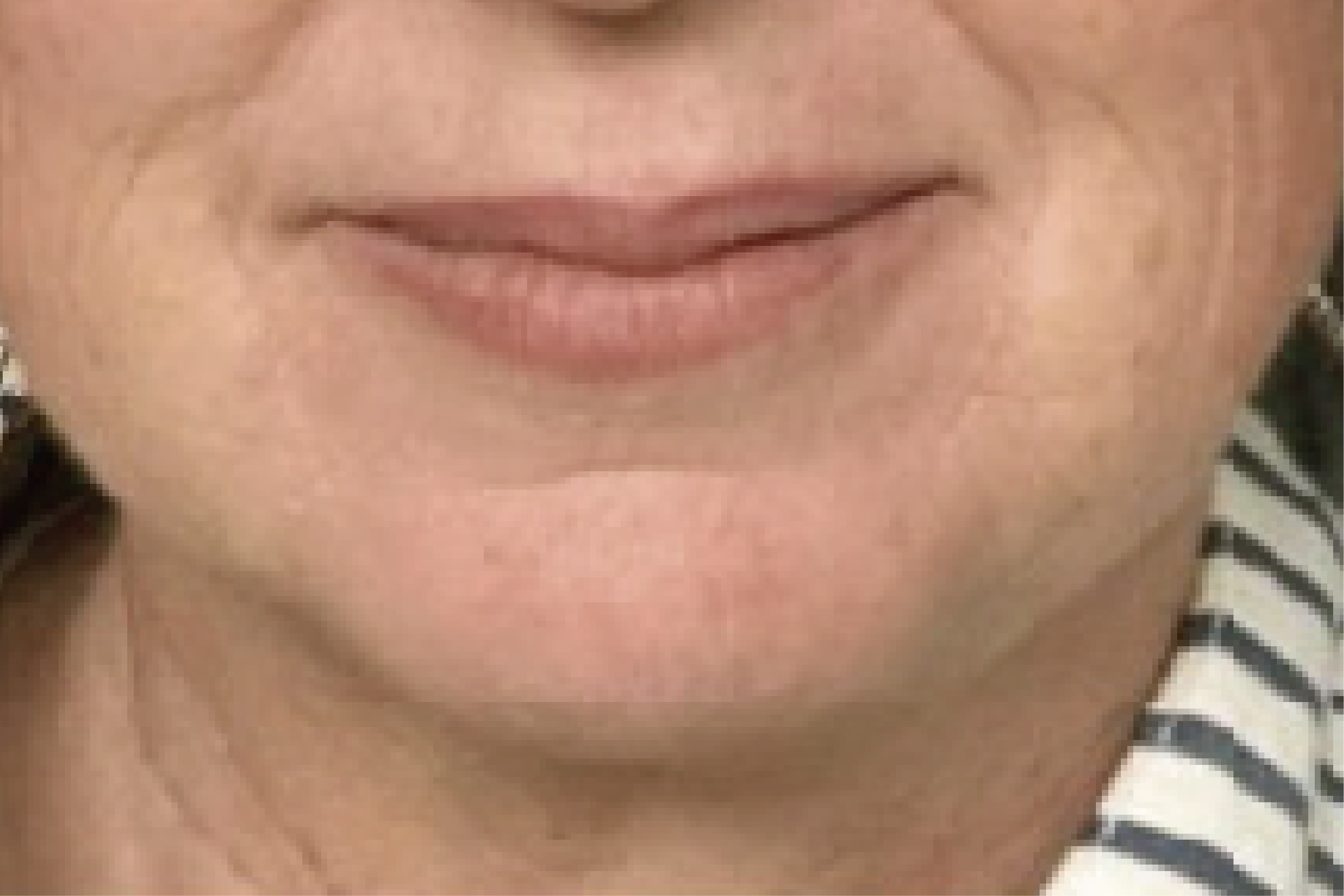 台中海芙音波推薦專業的醫美團隊『禾伊美學診所』