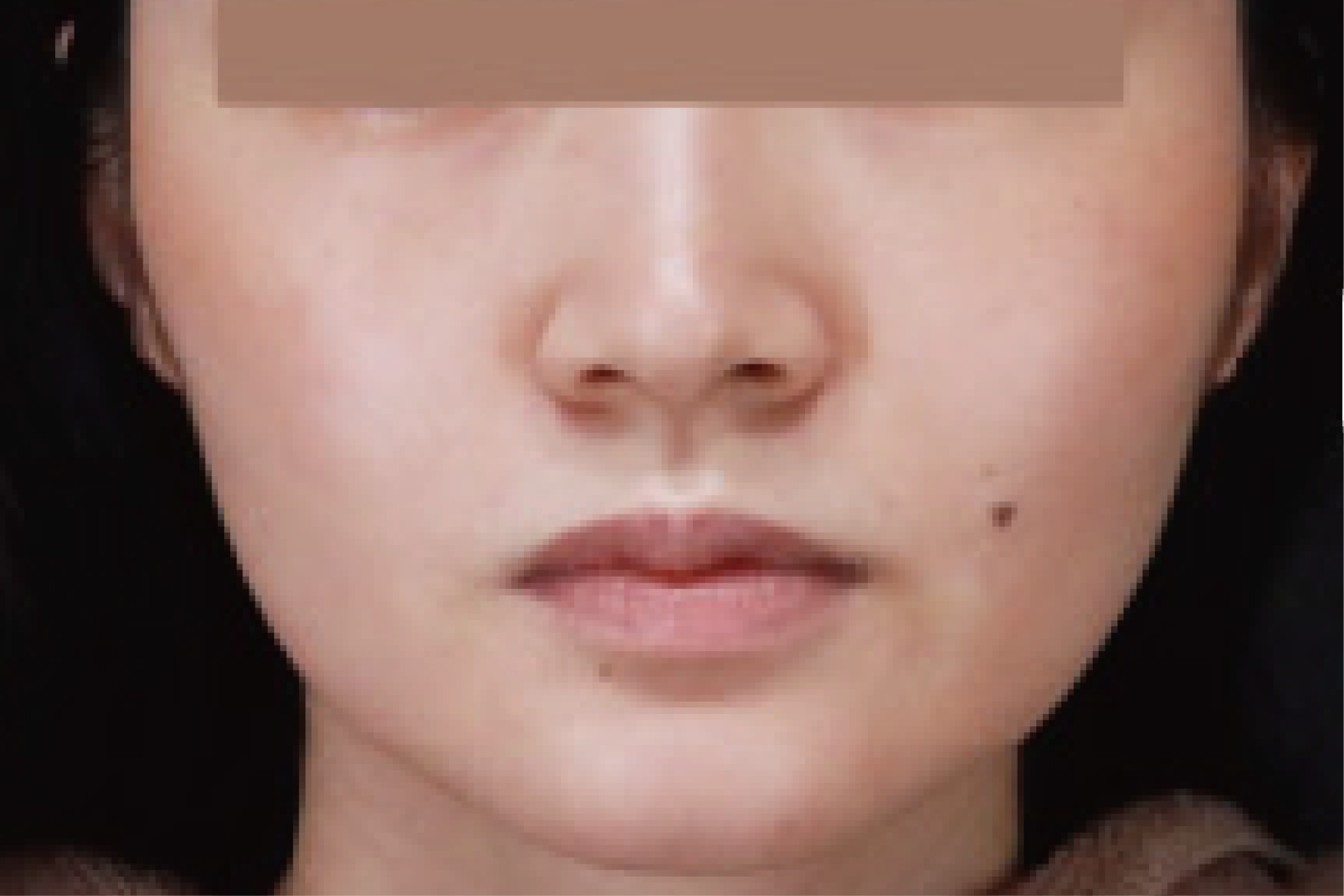 台中海芙音波推薦專業的醫美團隊『禾伊美學診所』